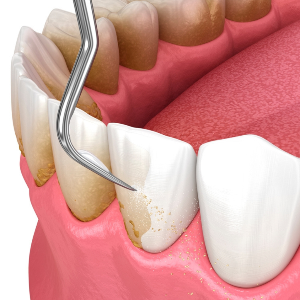 Scaling & Polishing - Palermo Dental Centre Scaling & Polishing - Palermo Dental Centre